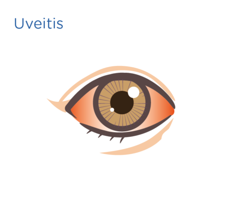 Common types of ocular infection | Keep Eyes In Sight