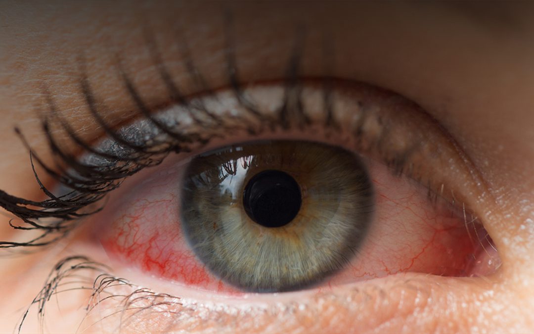 Grade your symptoms | Keep Eyes In Sight