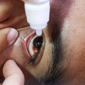 Resources for ocular infections | Keep Eyes In Sight