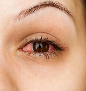Types of ocular allergy | Keep Eyes In Sight