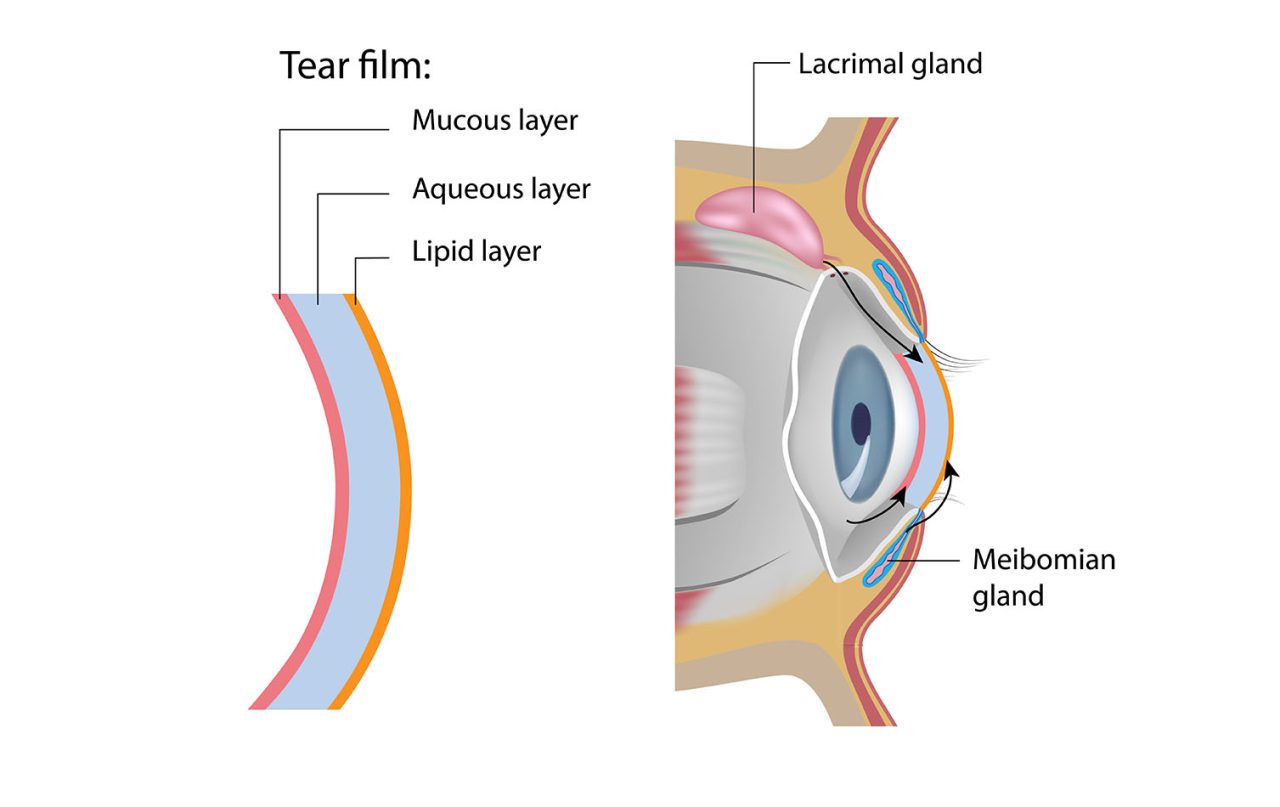 Types of Dry Eye Disease | Keep Eyes In Sight